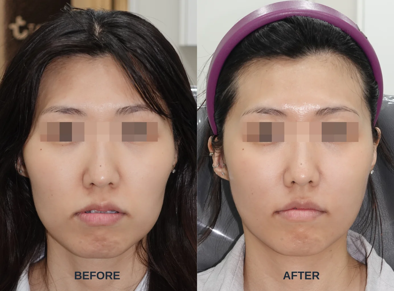 The "Peanut-Shaped" Face : Causes and Expert Solutions for Sunken ...
